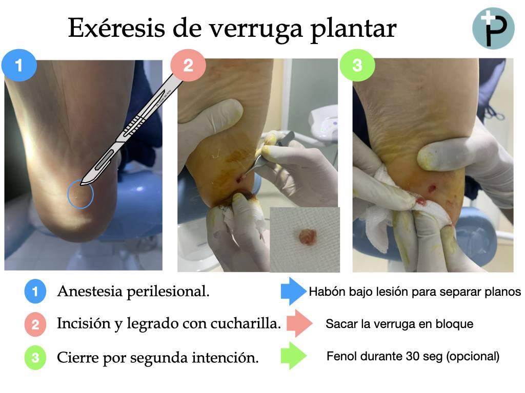 Eliminación de verruga plantar o papiloma